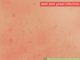Skin Infections - Bacterial, Viral, Fungal And Parasitic