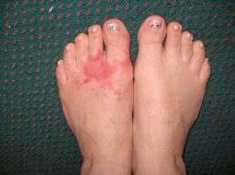 Fire Ant Bites - Symptoms And Associated Risk Factors