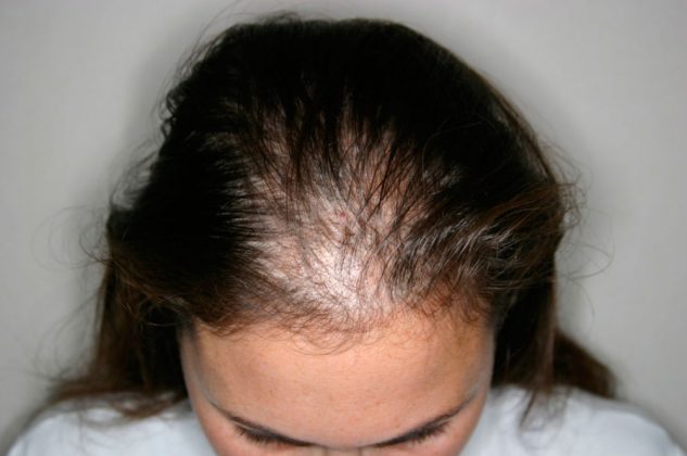 Alopecia In Women - Symptoms, Causes And Other Risk Factors