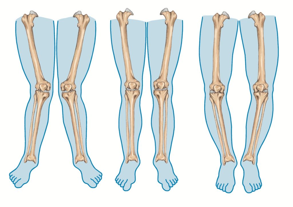 Bowlegs - Symptoms, Causes And Other Risk Factors