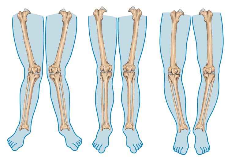 Bowlegs - Symptoms, Causes And Other Risk Factors