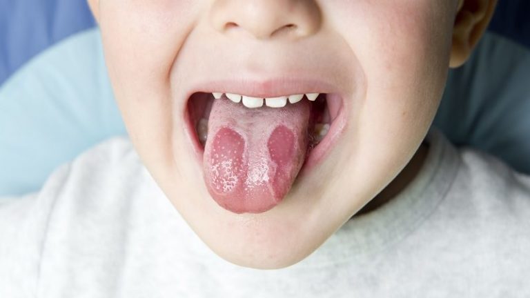 Natural Treatments For Burning Tongue Syndrome