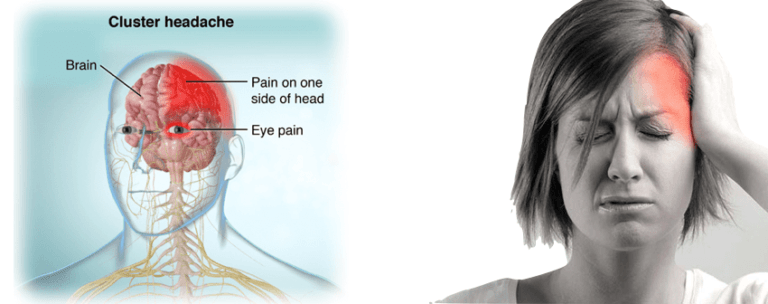 Cluster Headaches – Symptoms, Causes And Other Risk Factors