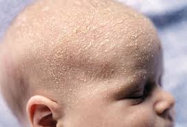 Cradle Cap - Causes, Symptoms And Other Related Information