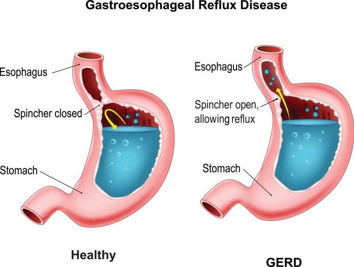 GERD: Symptoms, Causes, And Complications – Home Natural Cures