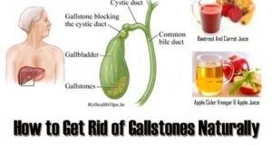 Gallstones - Top 8 Natural Treatments And Remedies