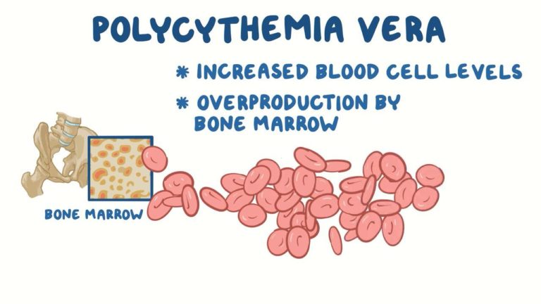Polycythemia Vera - Symptoms, Causes, Risk Factors & Complications