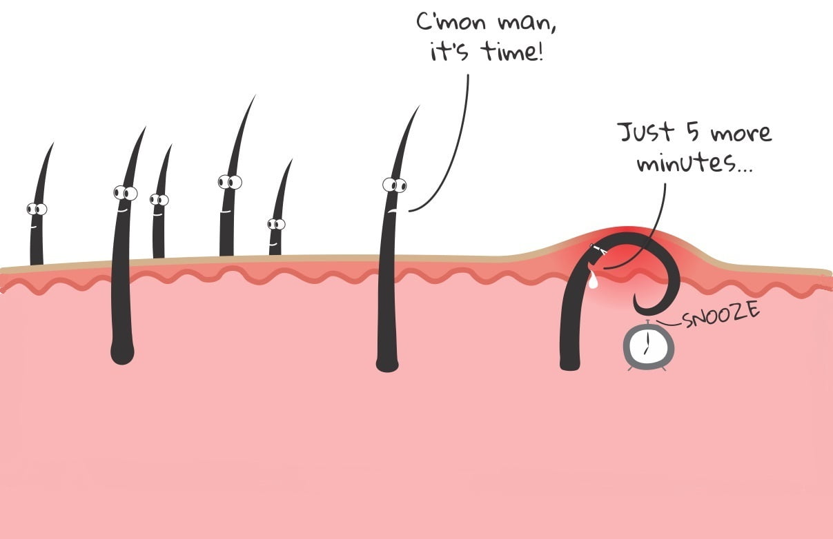 Ingrown Hair Cyst : Causes And Its Risk Factors