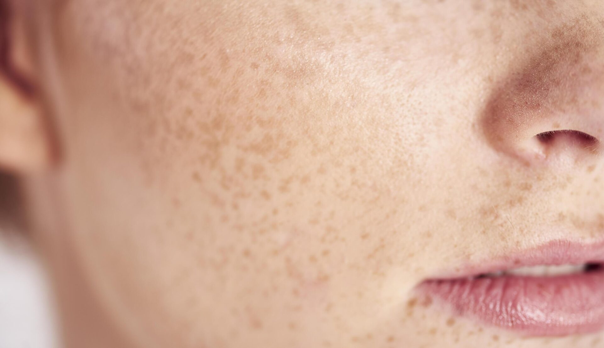 Freckles: Some Common Symptoms And Causes