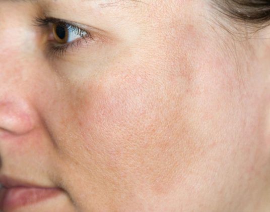 Melasma - Symptoms, Causes And Other Associated Risk Factors