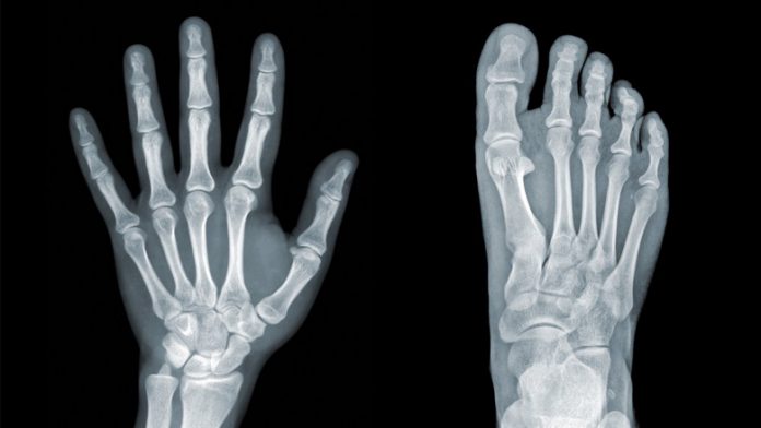 Osteopenia Symptoms, Risk Factors And Causes