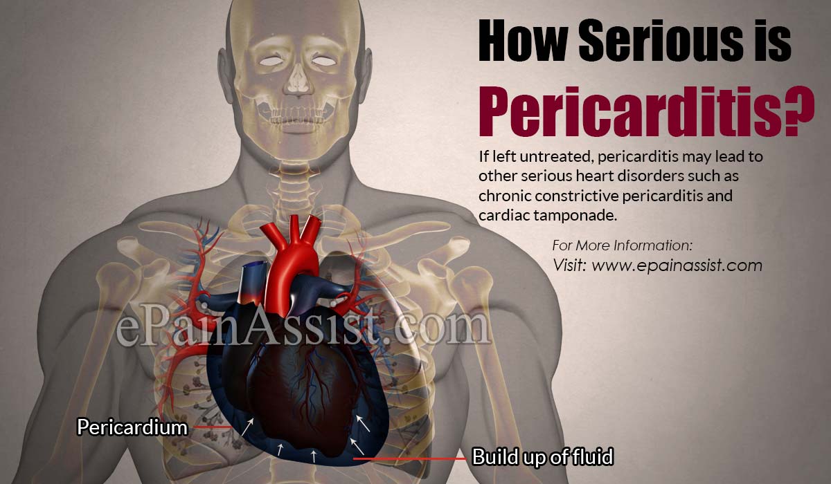 Pericarditis - Symptoms & Top 04 Causes