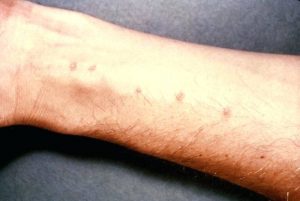 Pinworms Symptom , Causes And Complications