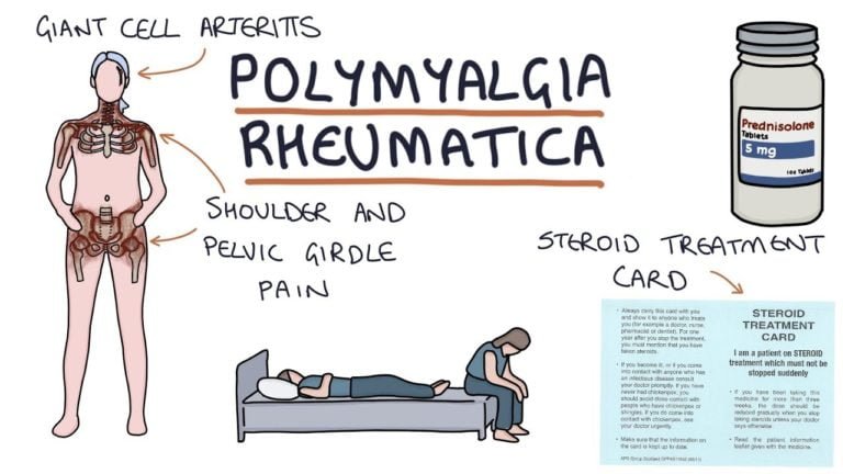 Polymyalgia Rheumatica - Natural Treatments & Home Remedies