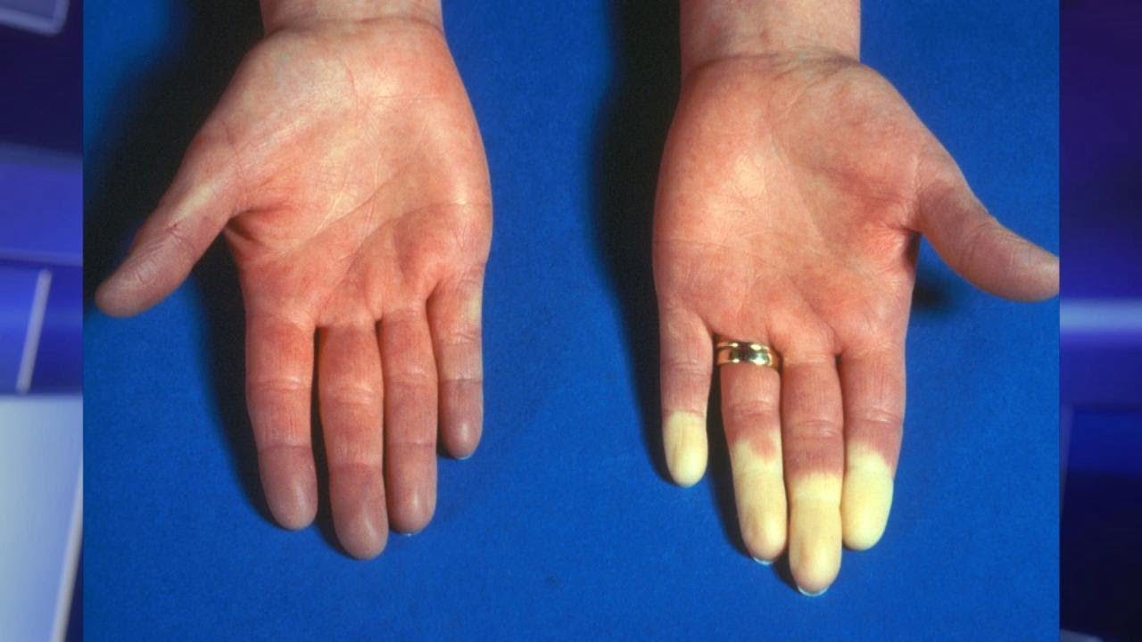 Raynaud's Disease Symptoms ,Causes And Risk Factors
