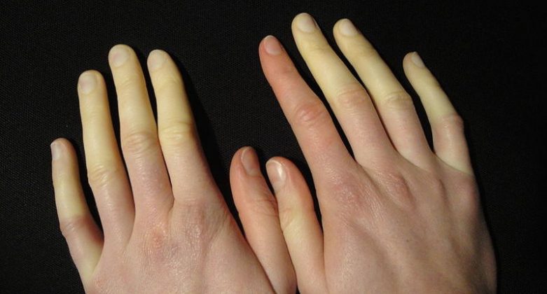 Raynaud's Disease Symptoms ,Causes And Risk Factors