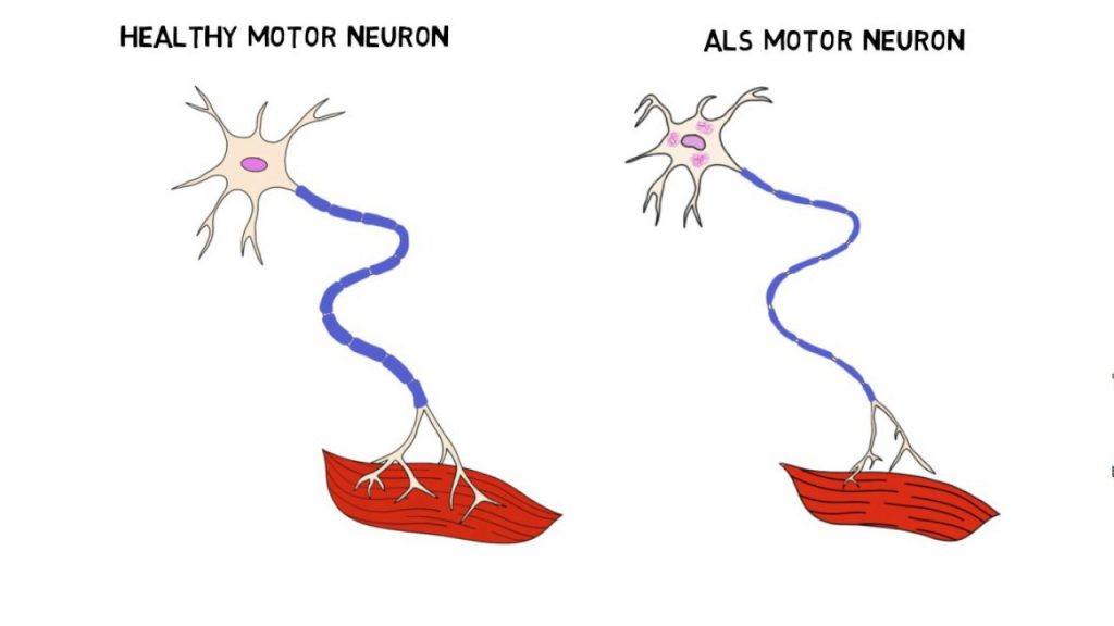 Amyotrophic Lateral Sclerosis (ALS) - Symptoms And Causes