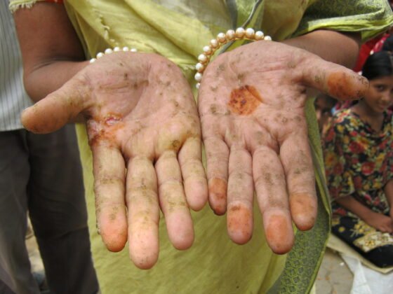 Arsenic Poisoning: Symptoms And Causes