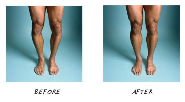Correct Bow Legs In Children Without Surgery Correct Bow Legs In Children Without Surgery