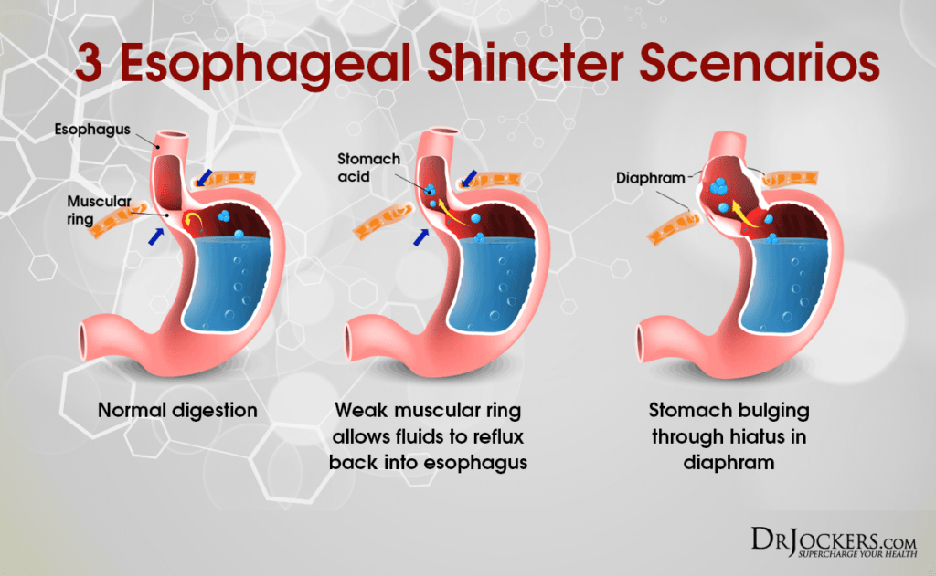 Biliary Reflux - Symptoms And Causes