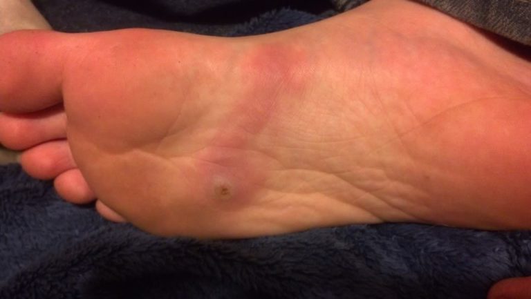 Blood Poisoning - Causes, Symptoms And Other Risk Factors