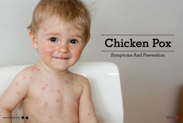 Signs And Symptoms Of Chickenpox Including Complications