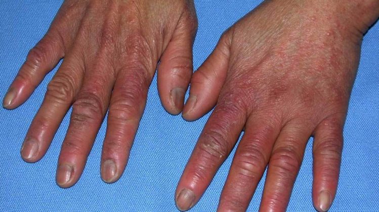 Chilblains - Symptoms And Causes