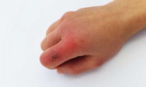 Chilblains - Symptoms And Causes