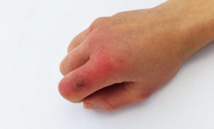 Chilblains - Symptoms And Causes