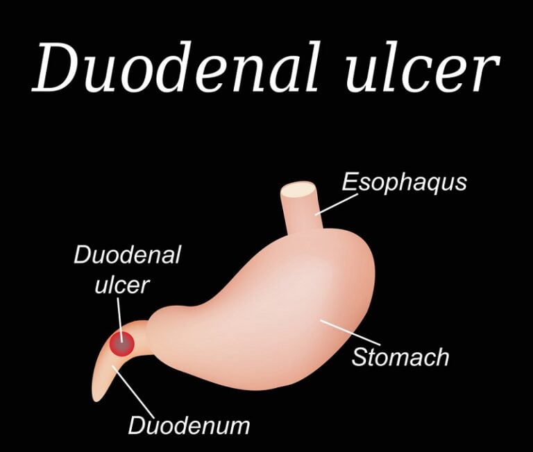 #1 Duodenal Ulcer - Symptoms And Causes