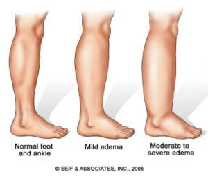 Edema - Symptoms, Causes And Other Associated Risk Factors