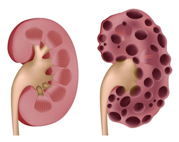 Kidney Cysts - Symptoms And Causes