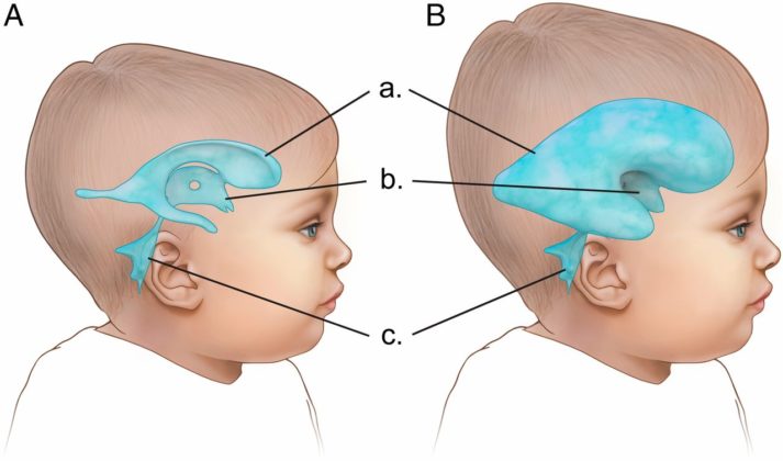 Hydrocephalus - Symptoms And Causes