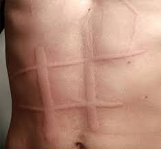 Dermatographic Urticaria: Top 13 Natural Treatment