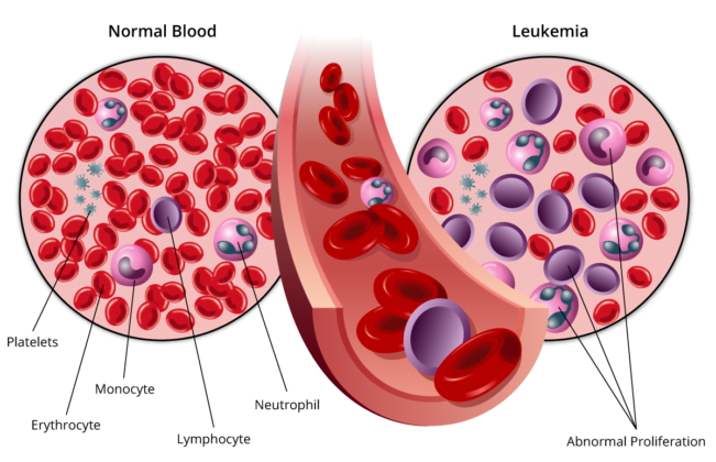 #1 Leukemia - Best Symptoms And Causes