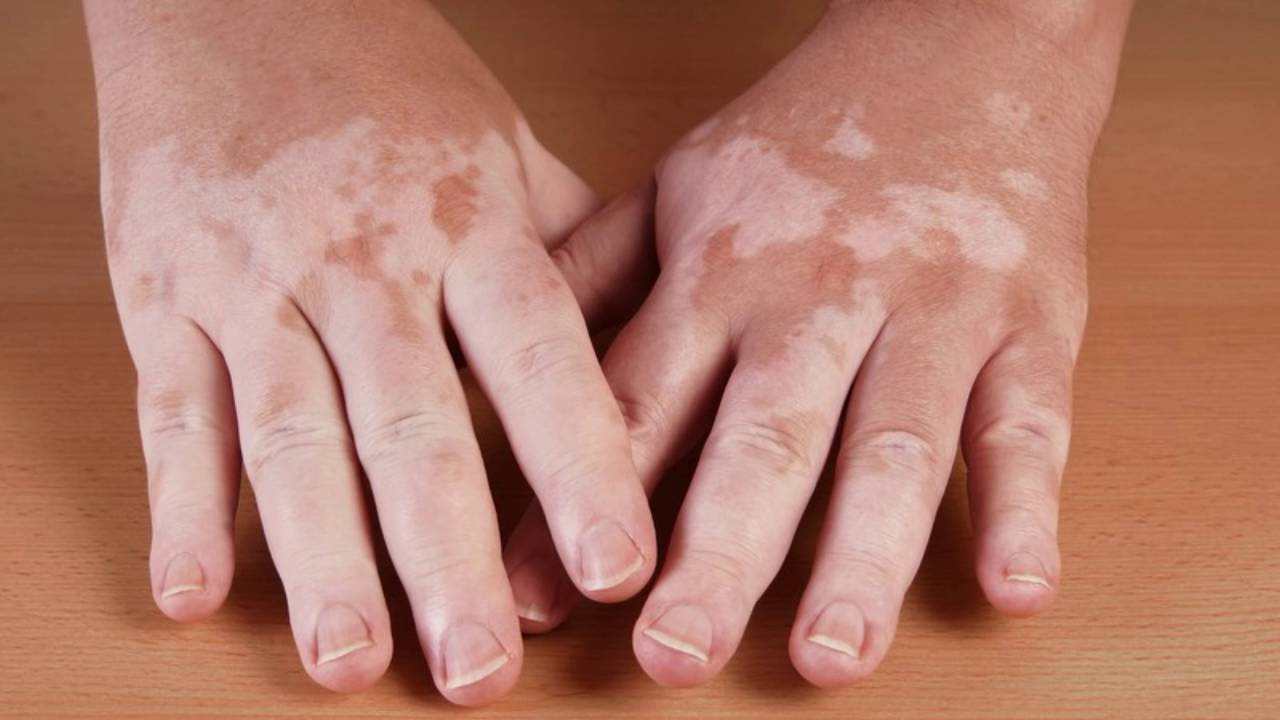 Leucoderma (vitiligo) - Symptoms And Causes