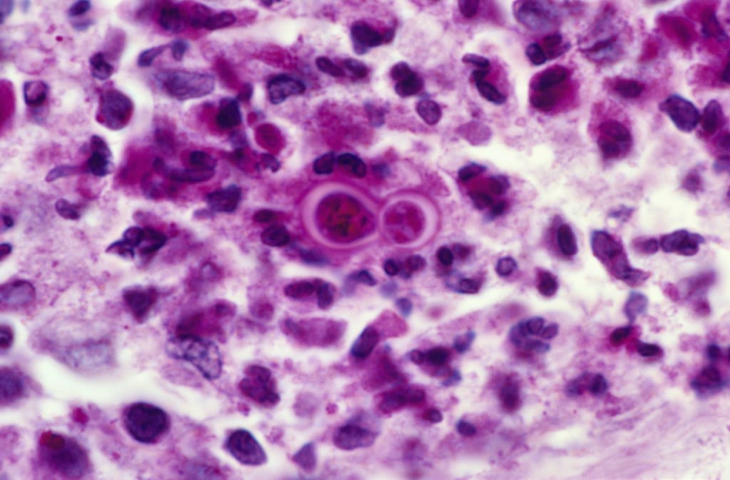 Blastomycosis - Symptoms, Causes And Other Risk Factors